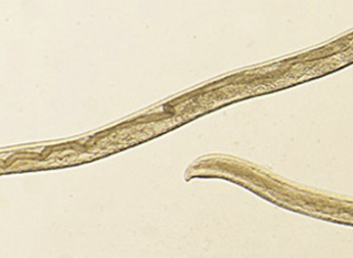 14 worms pulled from woman's eye after rare infection · TheJournal.ie